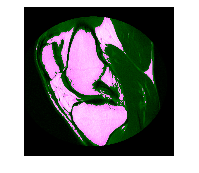 Use Freehand ROIs to Refine Segmentation Masks - MATLAB & Simulink