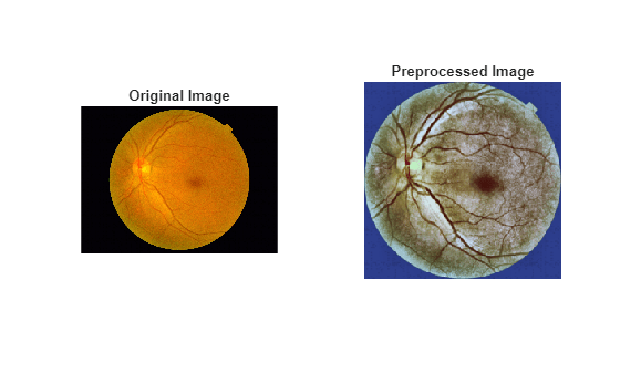 Multilabel Diabetic Retinopathy Fundus Image Classification Using Deep Learning - MATLAB & Simulink