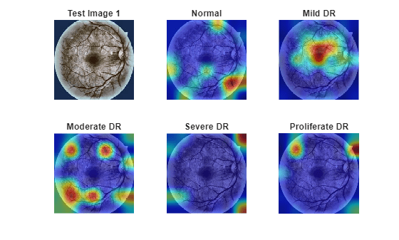 Multilabel Diabetic Retinopathy Fundus Image Classification Using Deep ...
