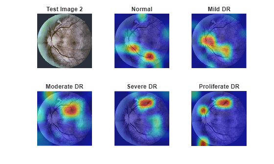 Multilabel Diabetic Retinopathy Fundus Image Classification Using Deep Learning - MATLAB & Simulink