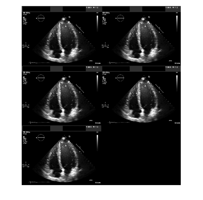 Specklefilt Filter Image Using Speckle Reducing Anisotropic Diffusion