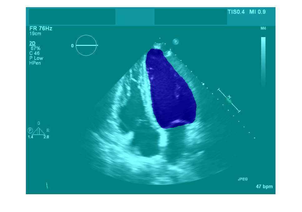 Convert Ultrasound Image Series into Training Data for 2-D Semantic ...
