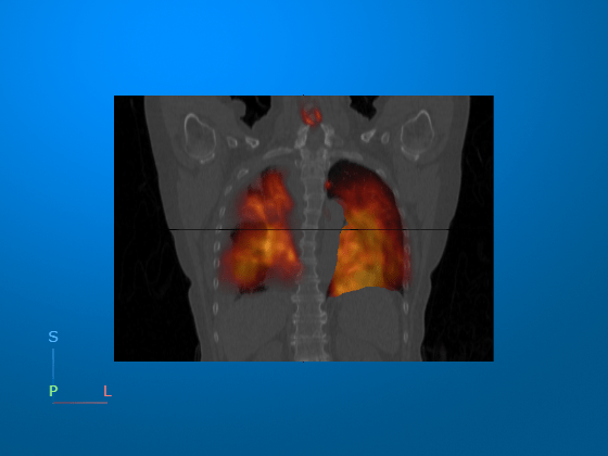 Display Multimodal Medical Image Data from PET and CT - MATLAB & Simulink