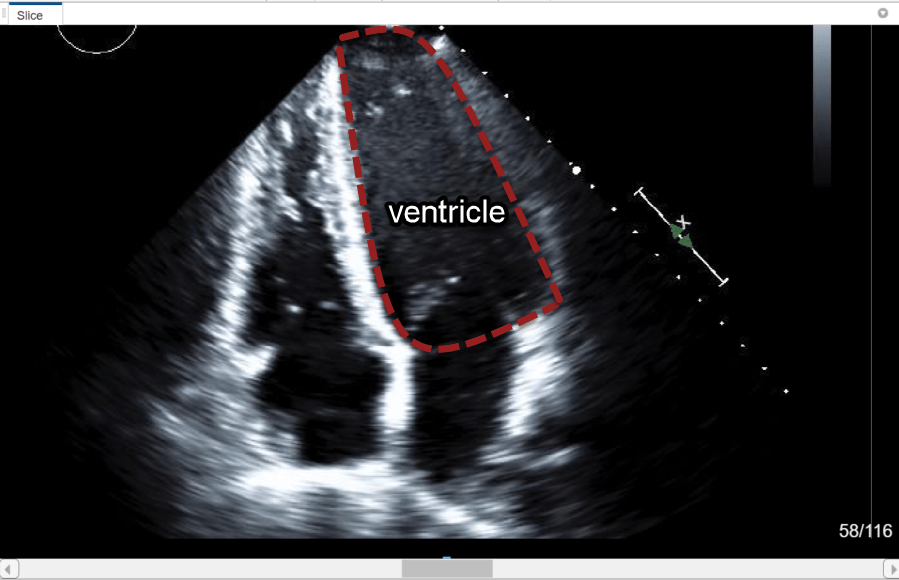 Label 2-D Ultrasound Series Using Medical Image Labeler - MATLAB & Simulink