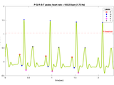 ECG QRS and Heart Rate Detection - File Exchange - MATLAB Central